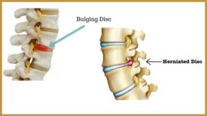 Bulging Disc vs. Herniated Disc: What’s the Difference? Can ...